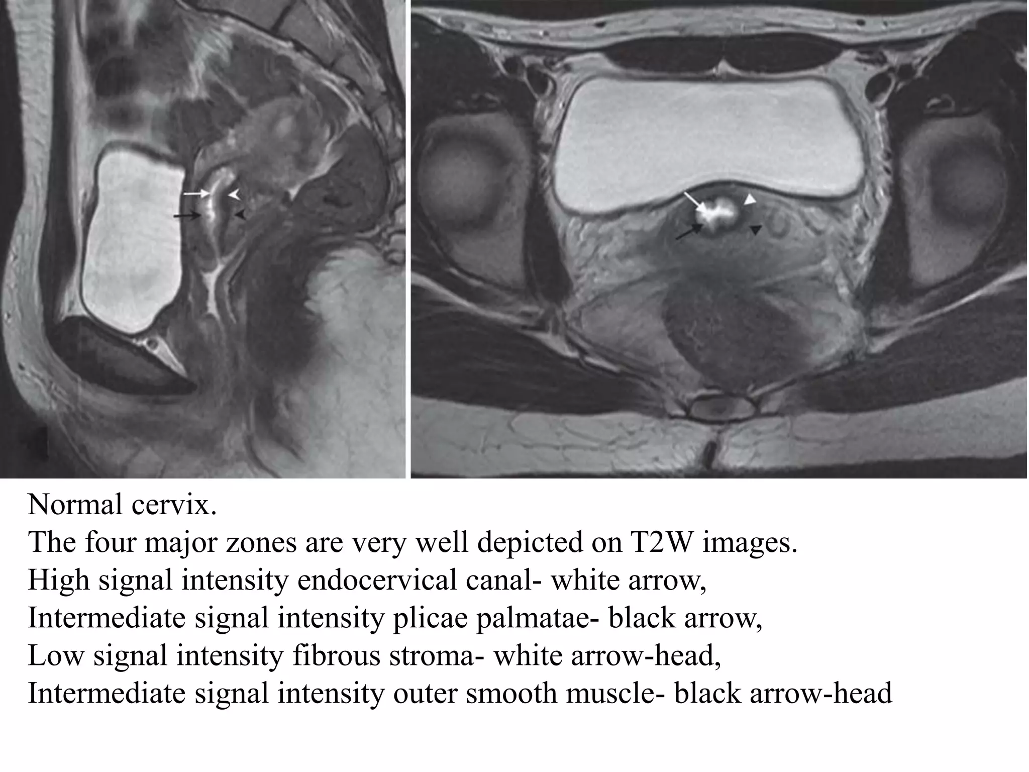 MRI carcinoma Uterus and Cervix | PPTX