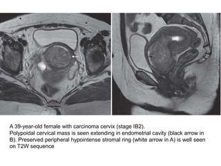 MRI carcinoma Uterus and Cervix | PPTX