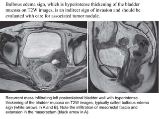 MRI carcinoma Uterus and Cervix | PPTX