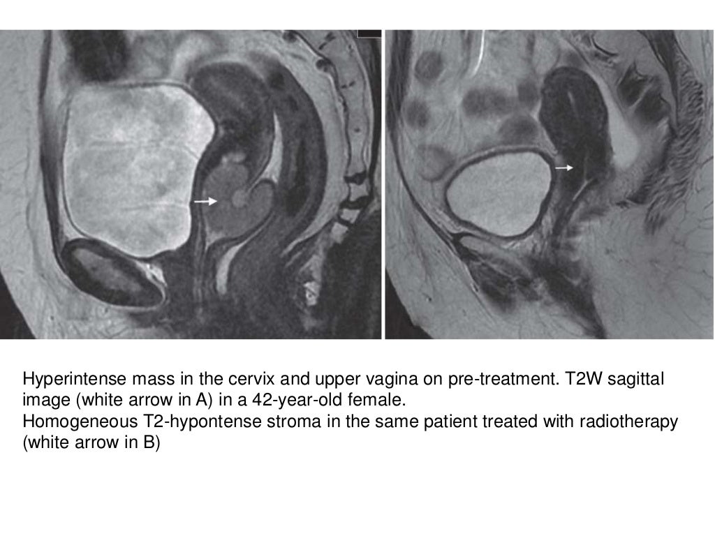 MRI carcinoma Uterus and Cervix