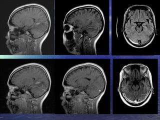 Mri cau truc tang tin hieu tren t1(bacsihoasung.wordpress.com) | PPT