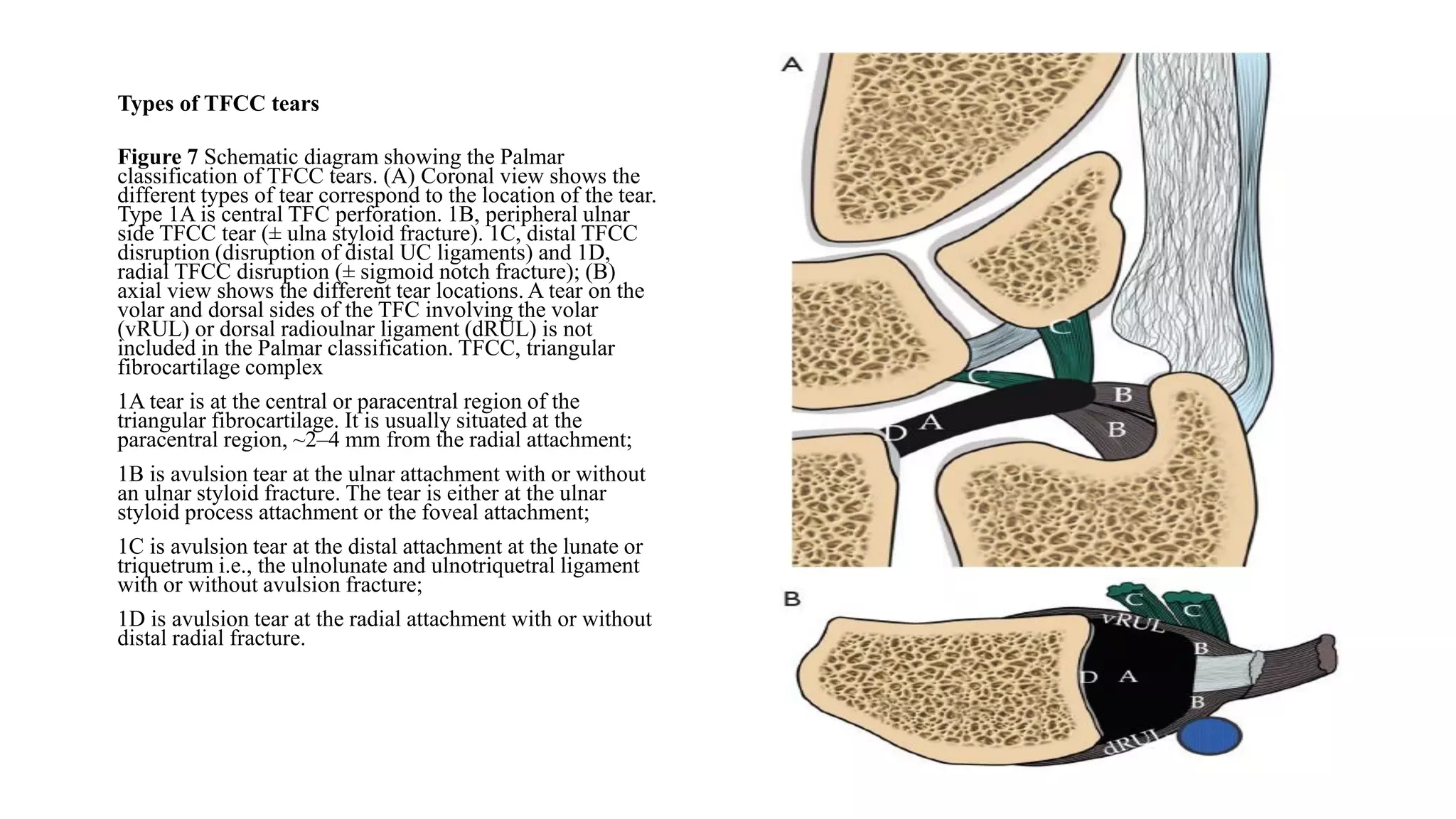 MRI chan thuong khop co tay dr duong | PDF