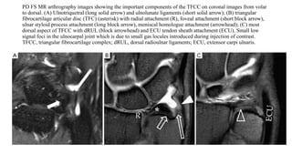 MRI chan thuong khop co tay dr duong | PDF