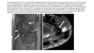 MRI chan thuong khop co tay dr duong | PDF
