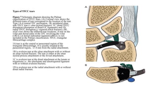 MRI chan thuong khop co tay dr duong | PDF