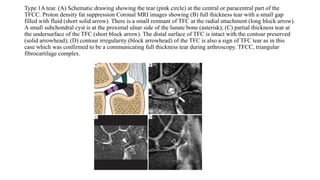 MRI chan thuong khop co tay dr duong | PDF