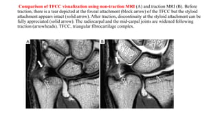 MRI chan thuong khop co tay dr duong | PDF