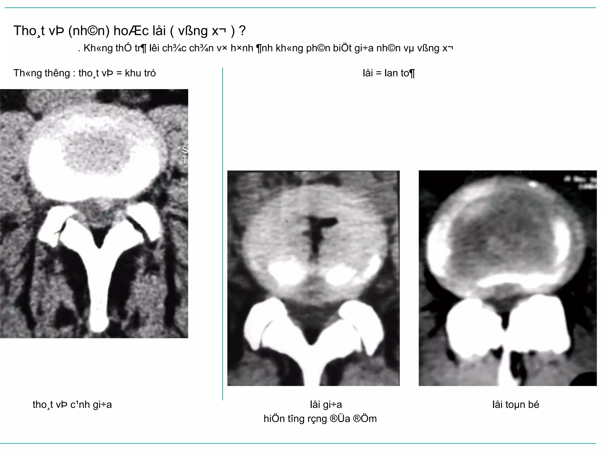 Mri cot song that lung 2(bacsihoasung.wordpress.com) | PPT