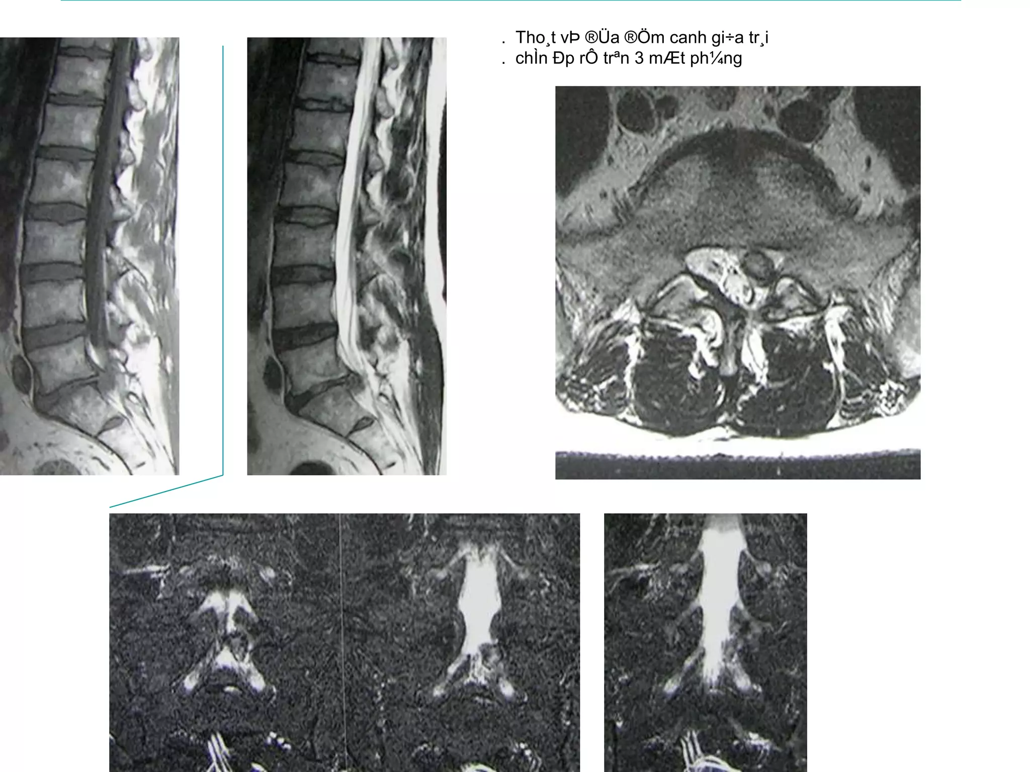 Mri cot song that lung 2(bacsihoasung.wordpress.com) | PPT