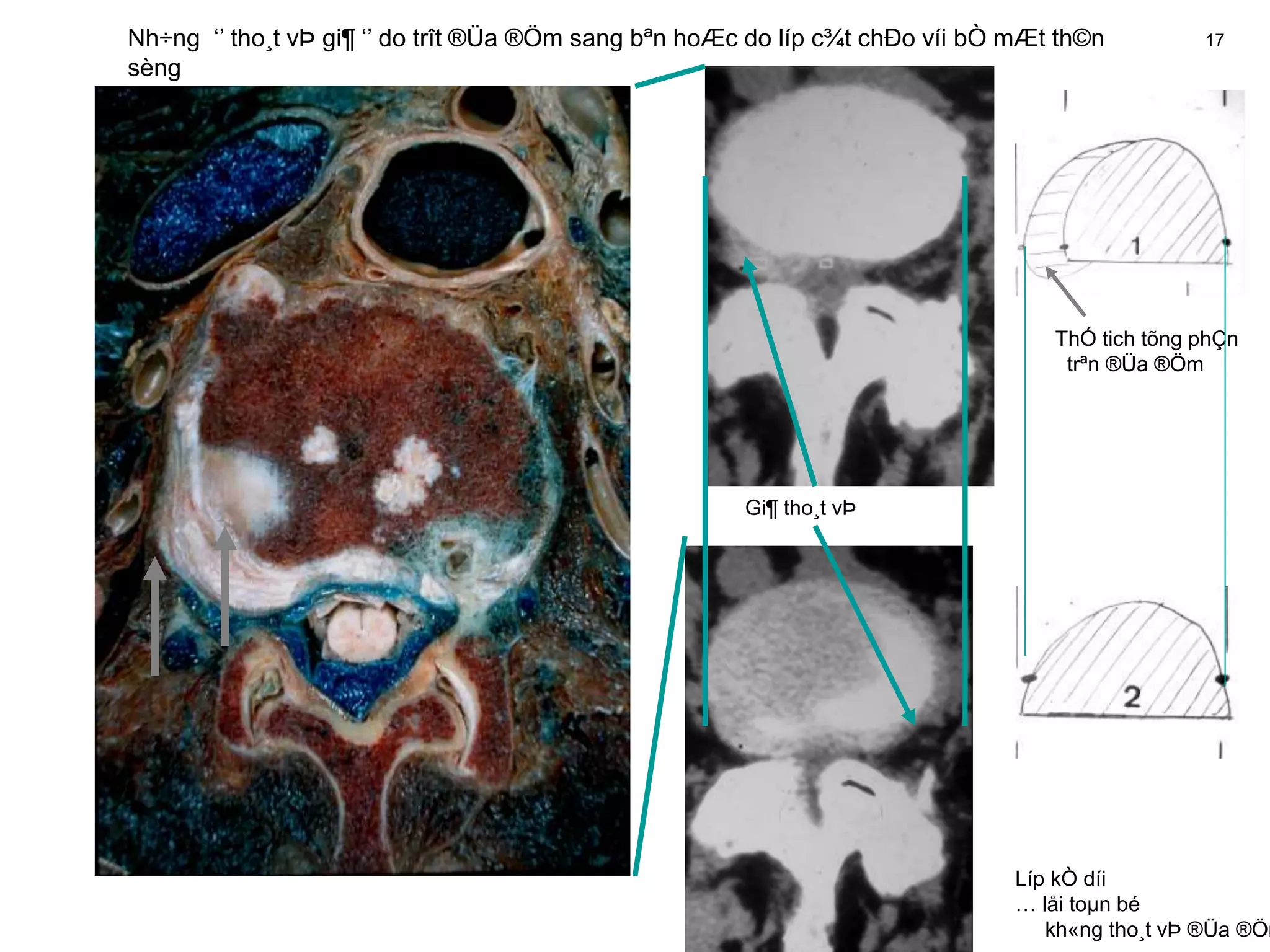 Mri cot song that lung 2(bacsihoasung.wordpress.com) | PPT