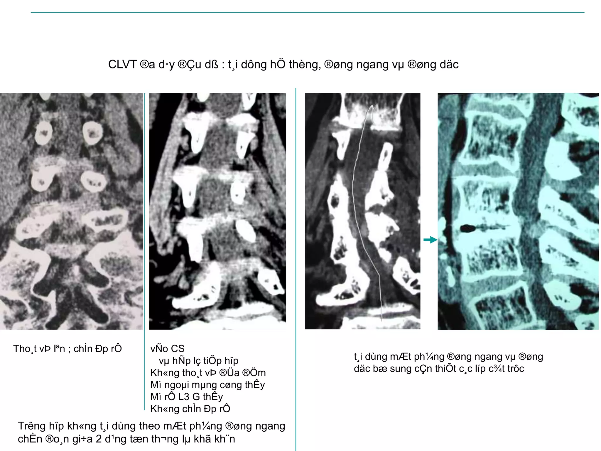 Mri cot song that lung 2(bacsihoasung.wordpress.com) | PPT