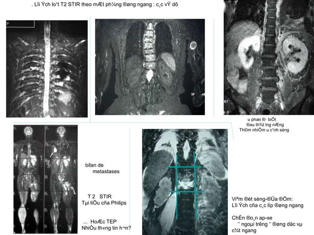 Mri cot song that lung 2(bacsihoasung.wordpress.com) | PPT