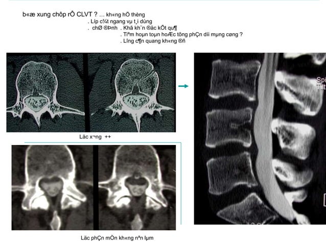 Mri cot song that lung 2(bacsihoasung.wordpress.com) | PPT