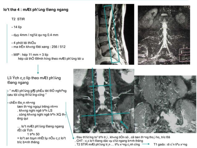 Mri cot song that lung 2(bacsihoasung.wordpress.com) | PPT