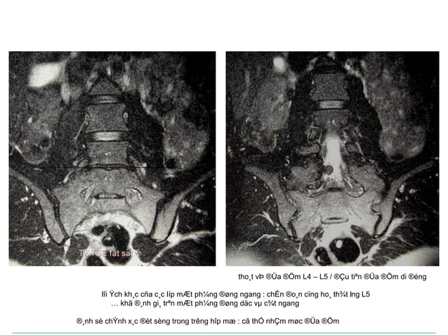 Mri cot song that lung 2(bacsihoasung.wordpress.com) | PPT