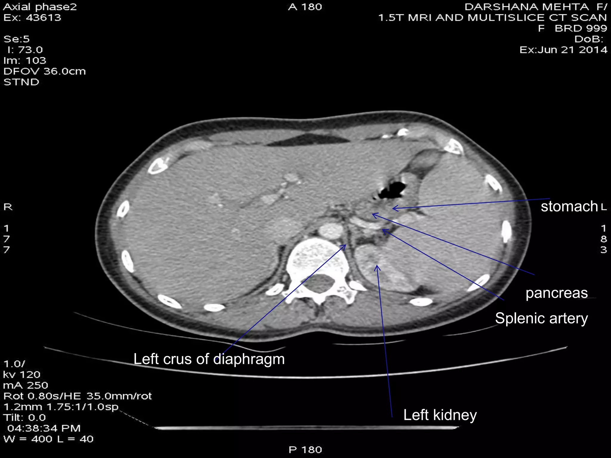 MRI and CT of ADRENAL GLAND | PPTX | Endocrine and Metabolic Diseases ...