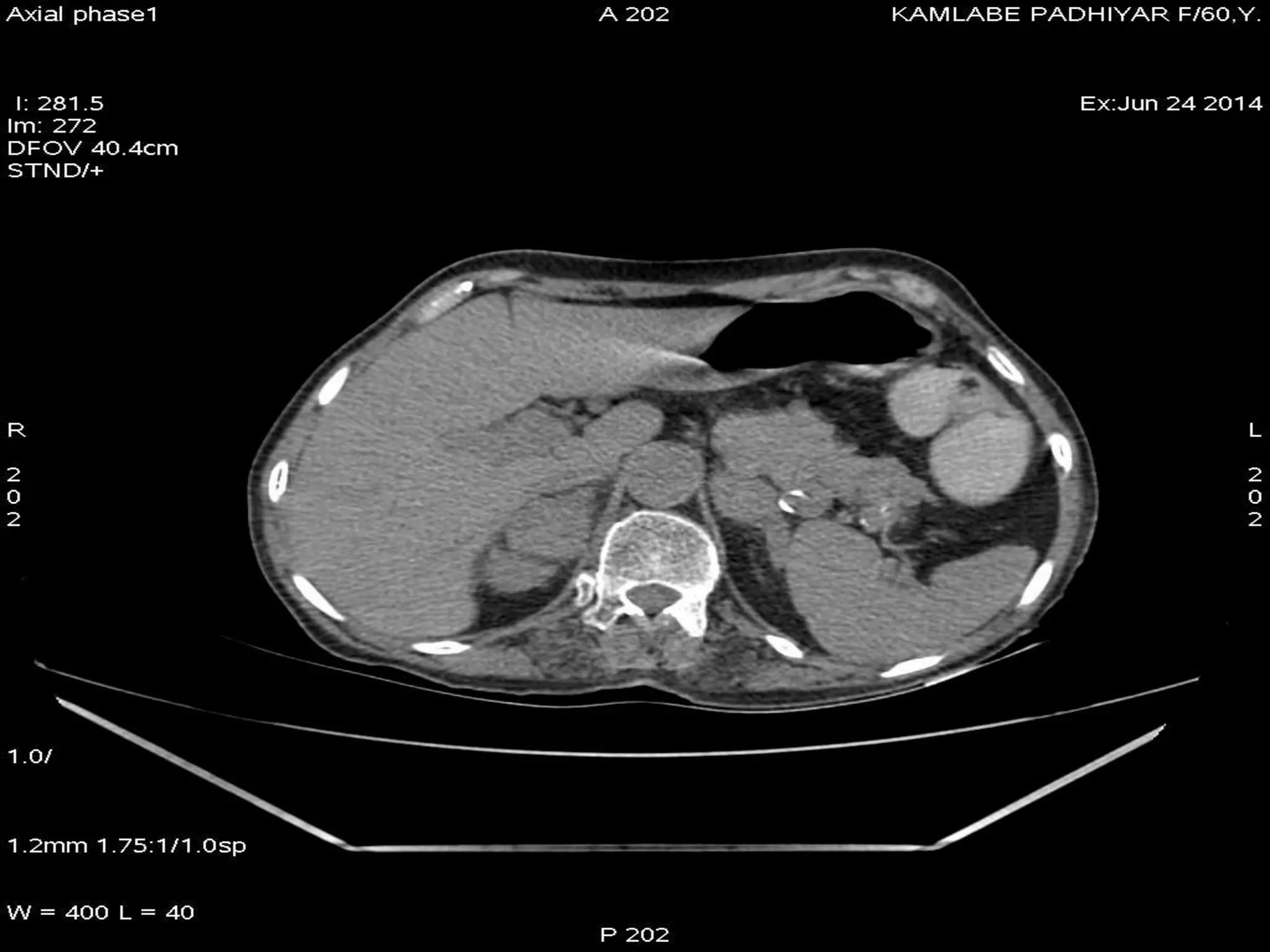 MRI and CT of ADRENAL GLAND | PPTX | Endocrine and Metabolic Diseases ...