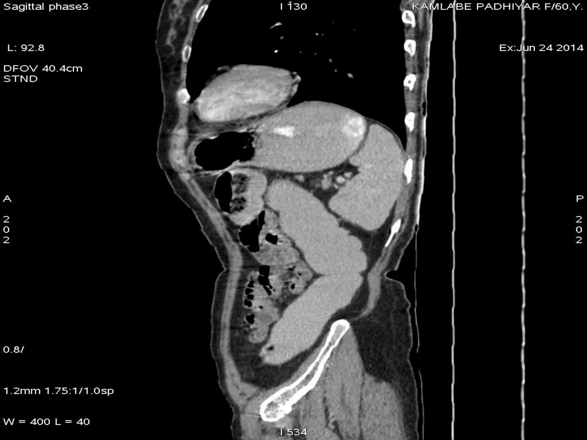 MRI and CT of ADRENAL GLAND | PPTX | Endocrine and Metabolic Diseases ...