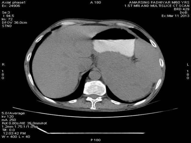 MRI and CT of ADRENAL GLAND | PPTX | Endocrine and Metabolic Diseases ...