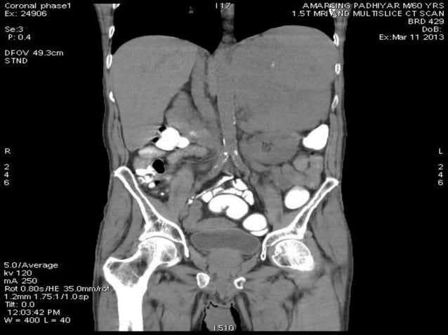 MRI and CT of ADRENAL GLAND | PPTX | Endocrine and Metabolic Diseases ...
