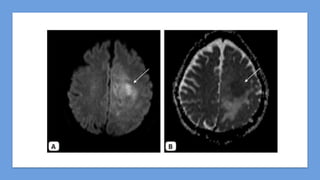 mri diffusion .pptx