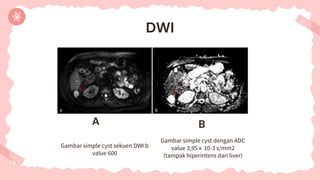 MRI DWI dan FLAIR pada kista hati.pptx