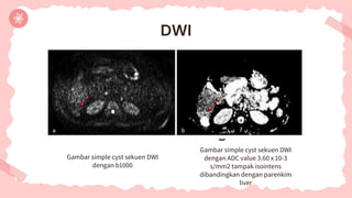 MRI DWI dan FLAIR pada kista hati.pptx