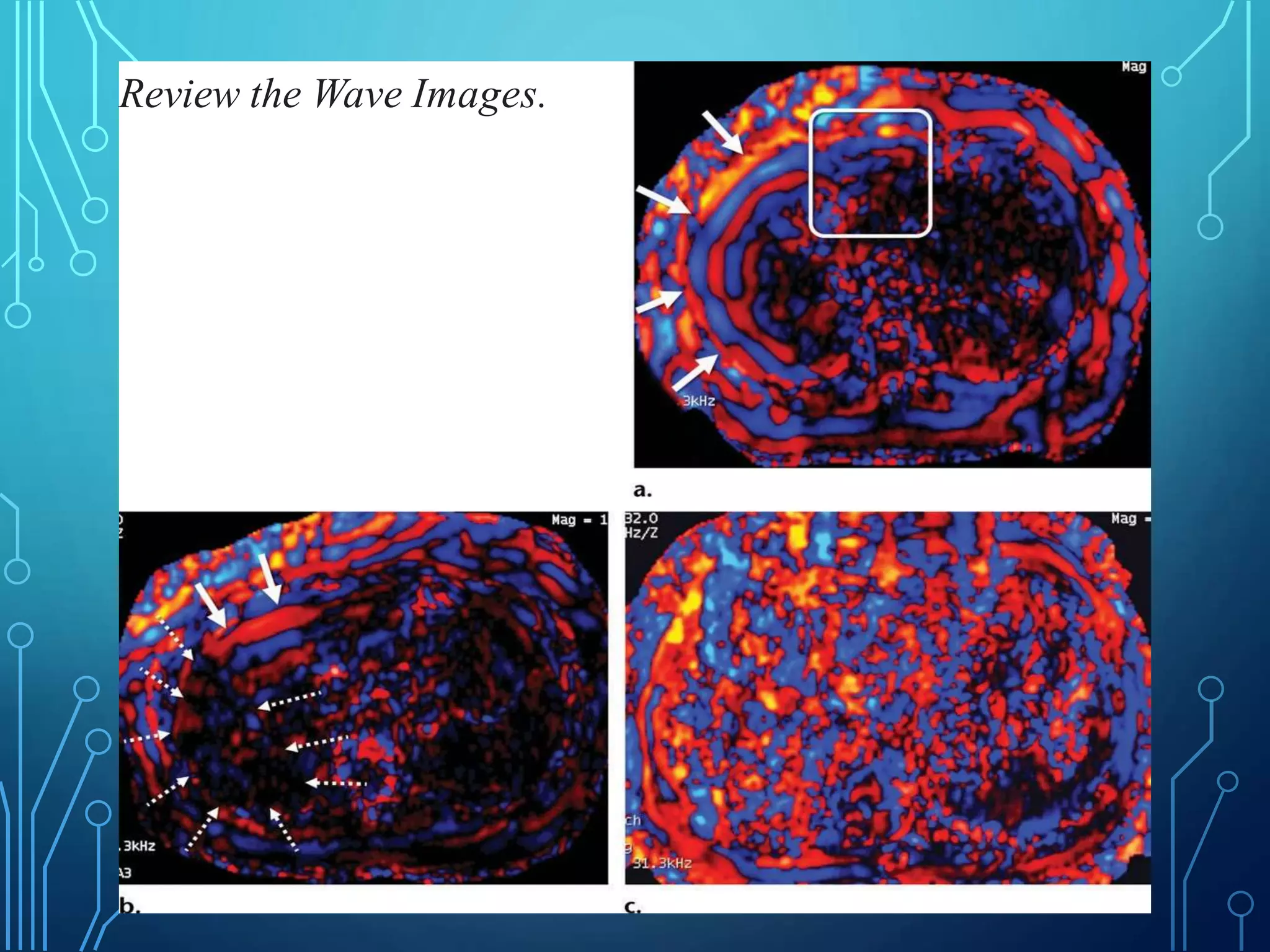 Mri elastography | PPTX