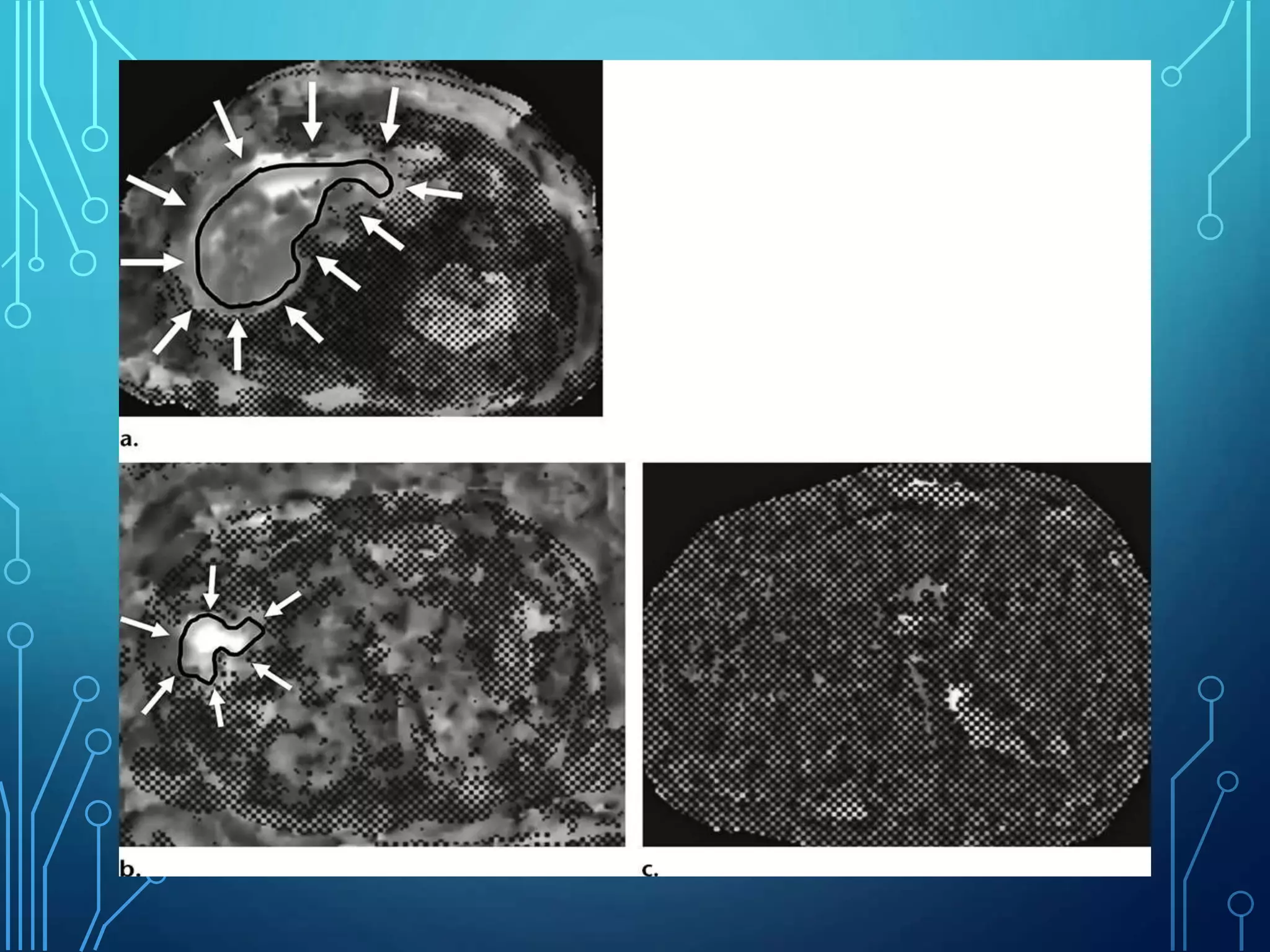 Mri elastography | PPTX