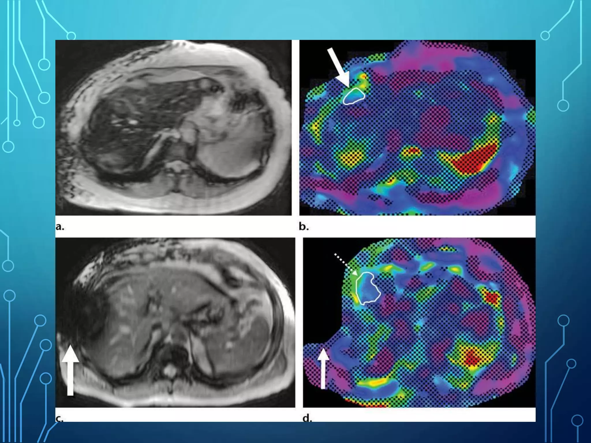Mri elastography | PPTX