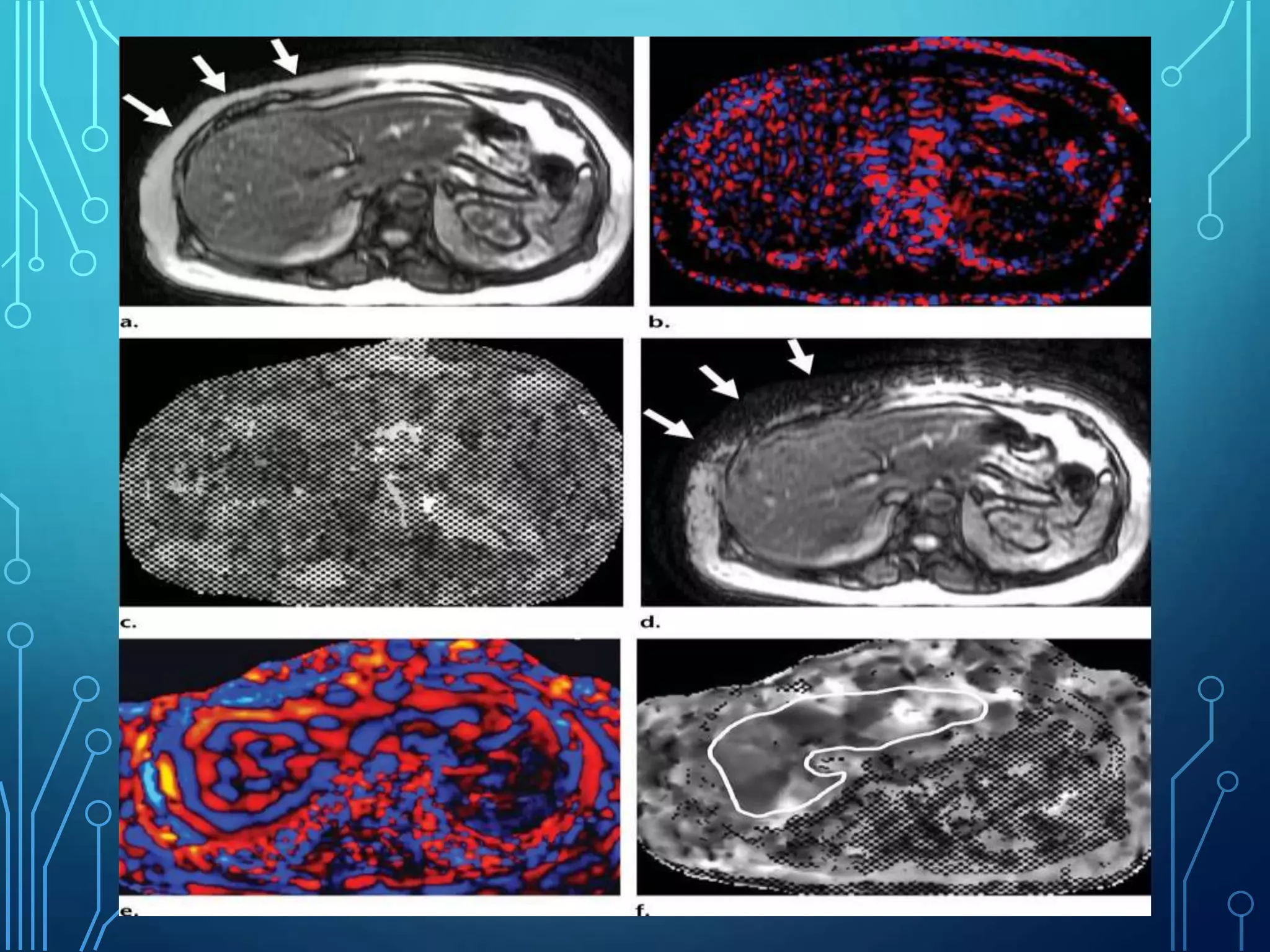 Mri elastography | PPTX