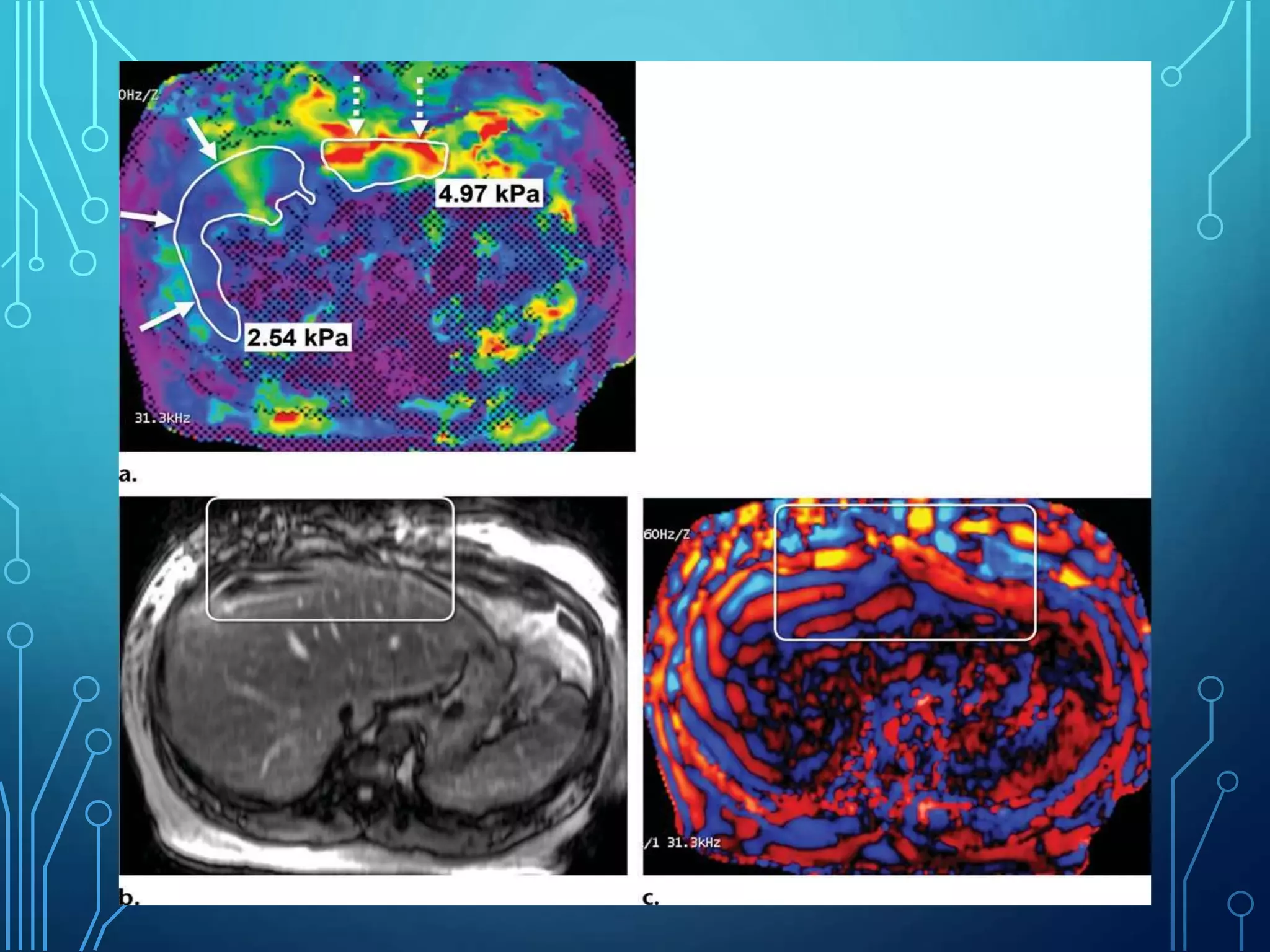 Mri elastography | PPTX
