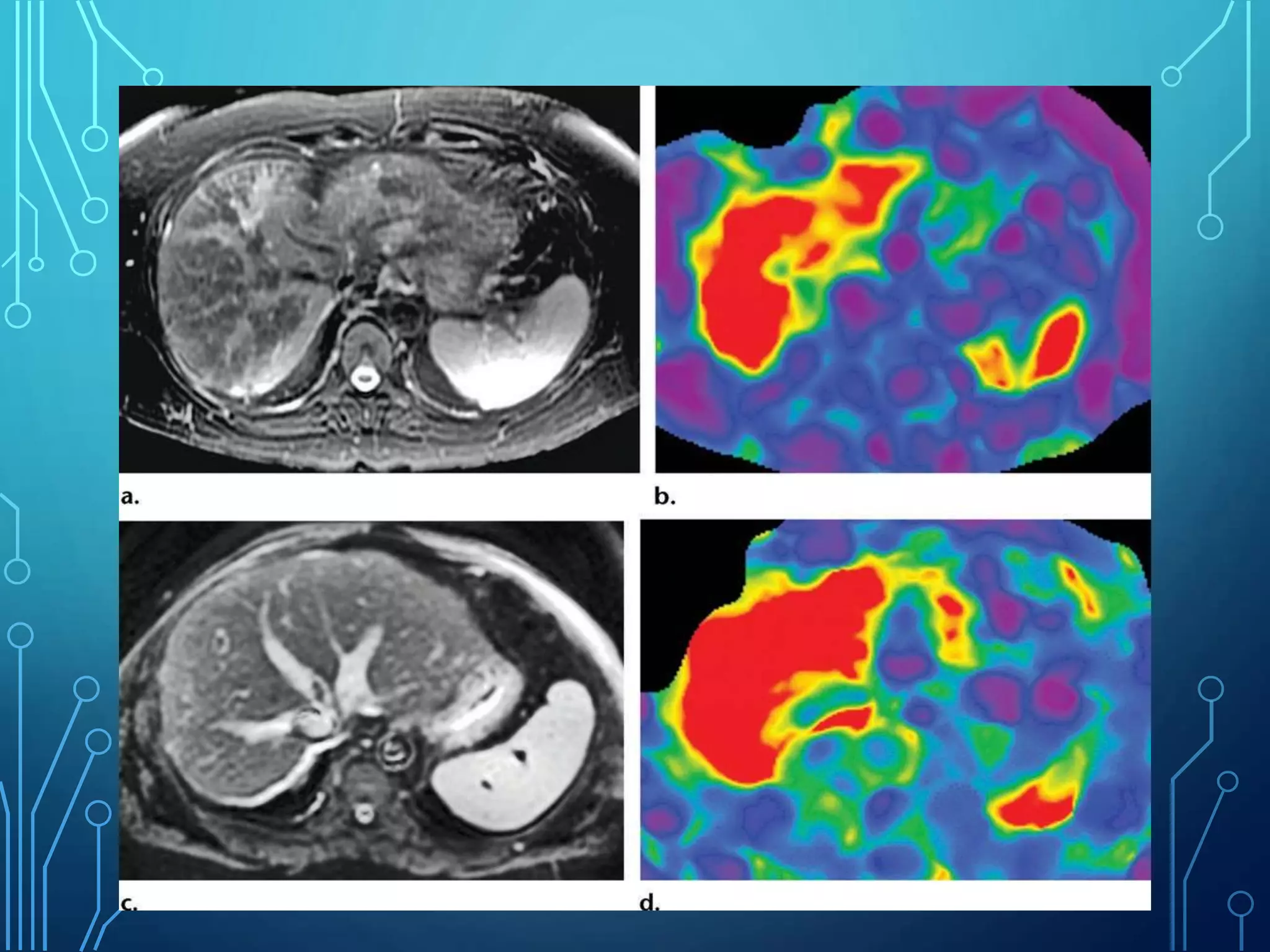 Mri elastography | PPTX
