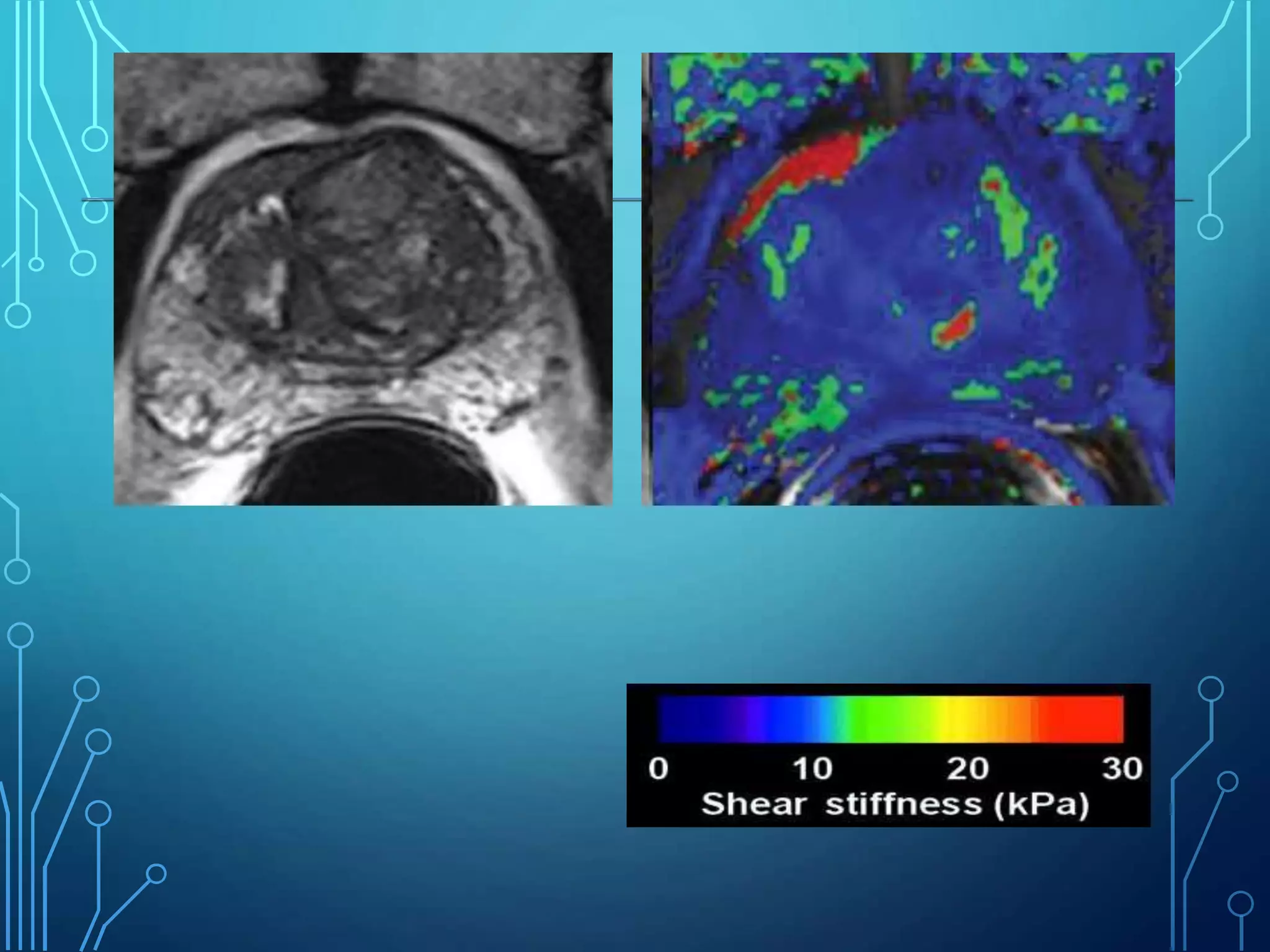 Mri elastography | PPTX