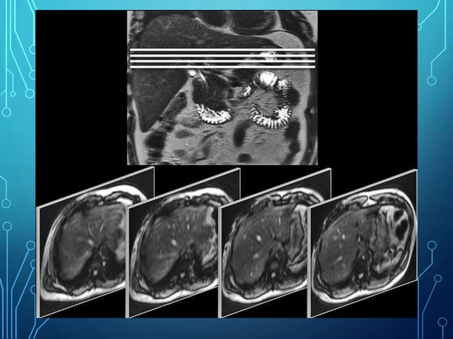 Mri elastography | PPTX