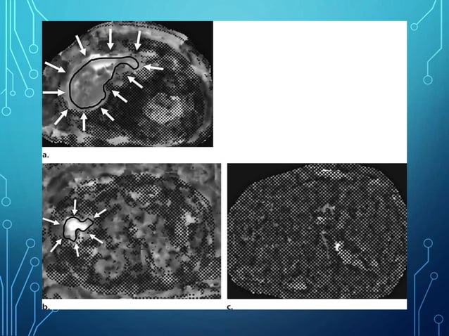 Mri elastography | PPTX