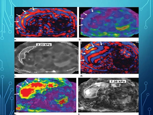 Mri elastography | PPTX