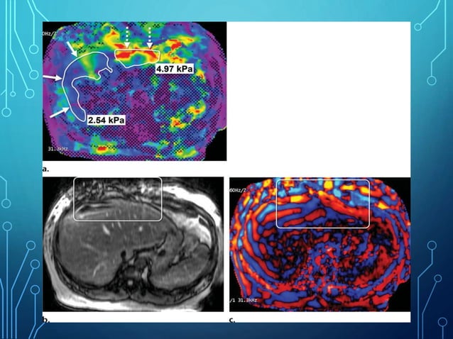 Mri elastography | PPTX