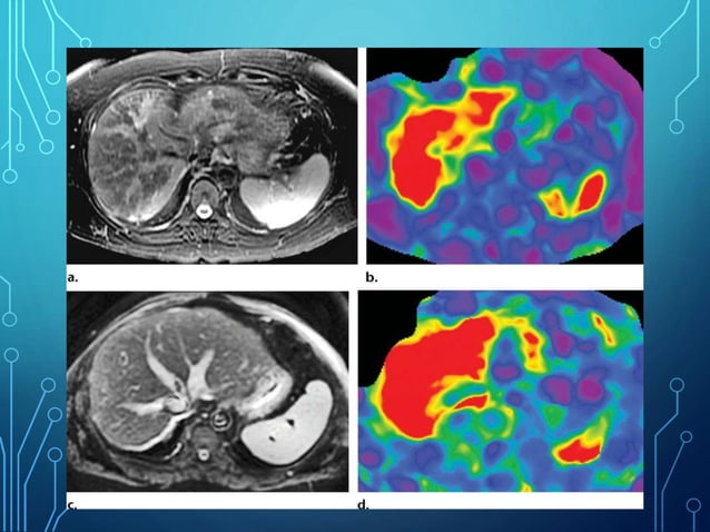 Mri elastography | PPTX