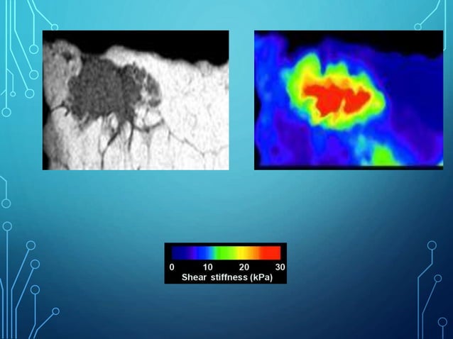 Mri elastography | PPTX