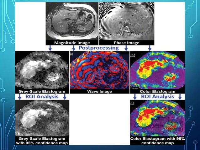 Mri elastography | PPTX