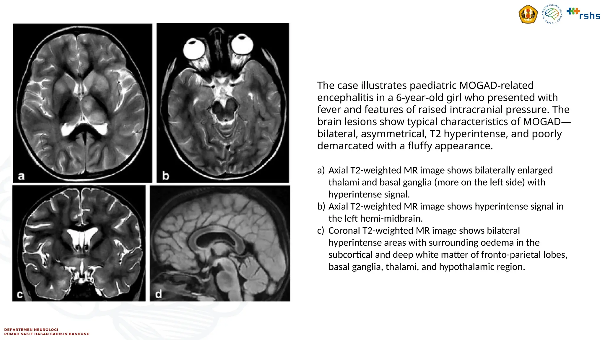 MRI Features of Myelin Oligodendrocyte Glycoprotein Antibody Disease.pptx