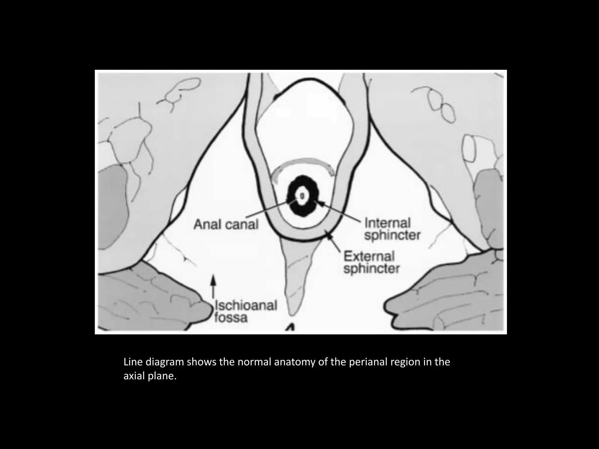 MRI fistulogram | PDF