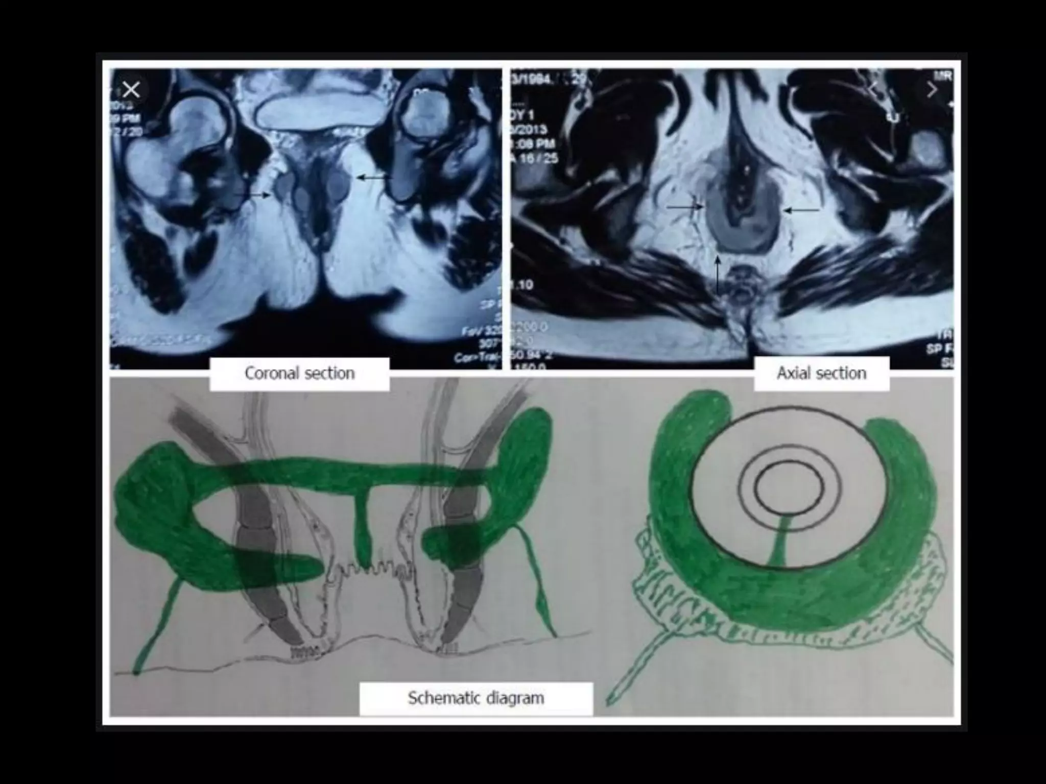 MRI fistulogram | PDF