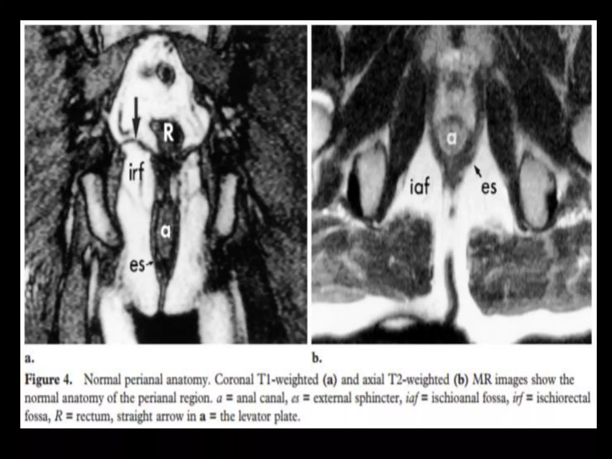 MRI fistulogram | PDF
