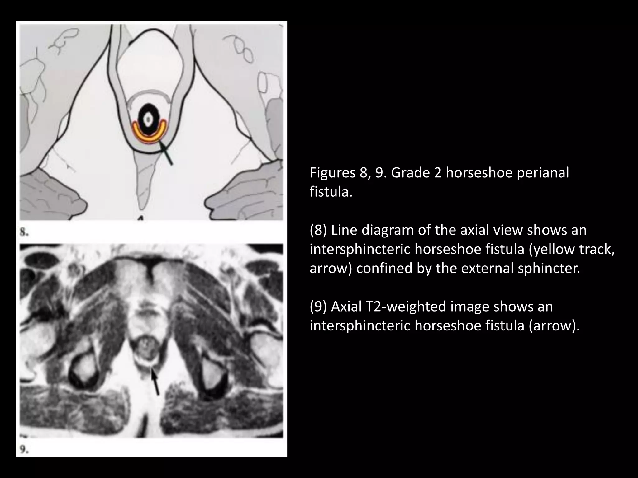 MRI fistulogram | PDF