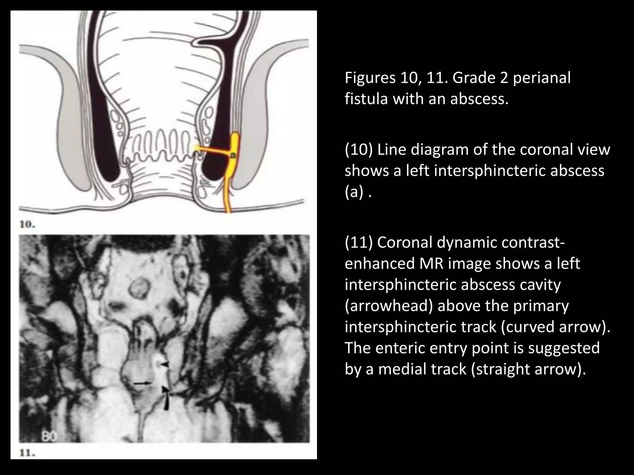 MRI fistulogram | PDF