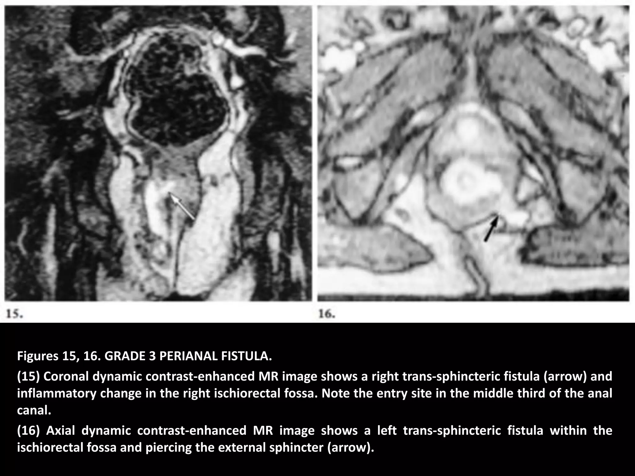 MRI fistulogram | PDF