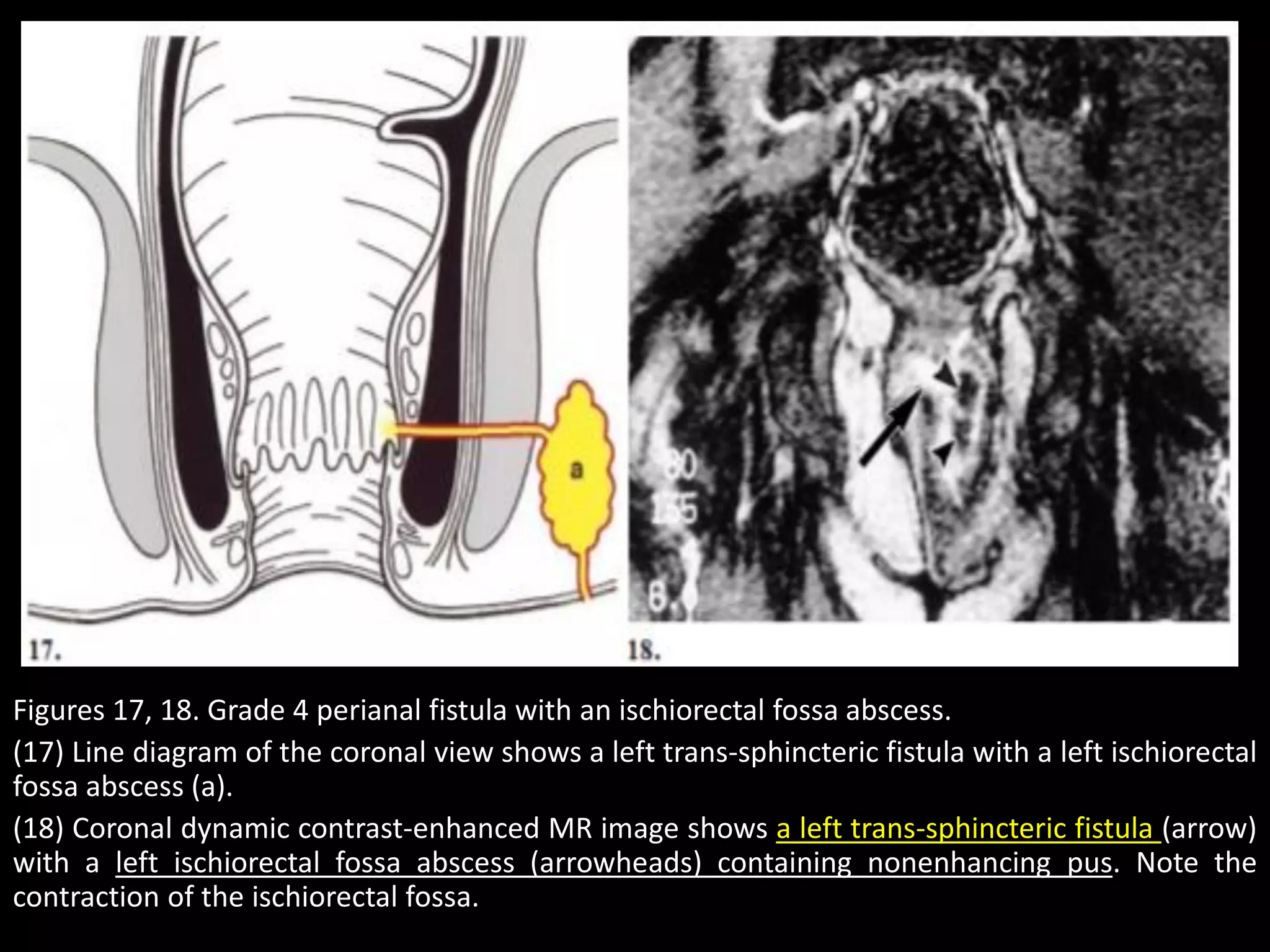 MRI fistulogram | PDF