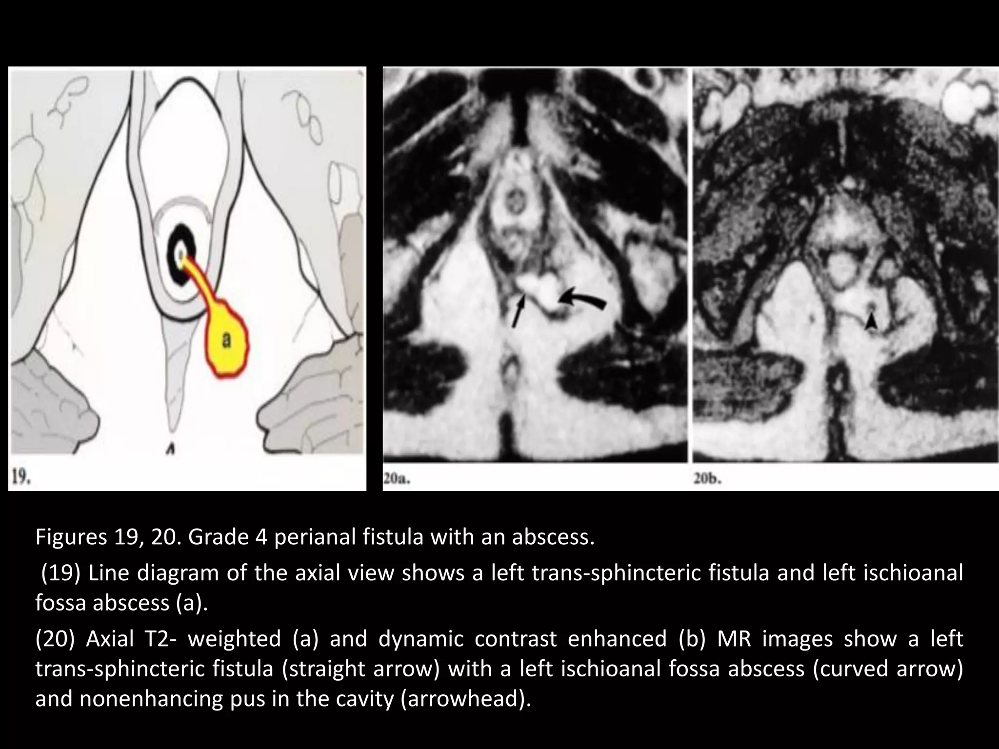 MRI fistulogram | PDF